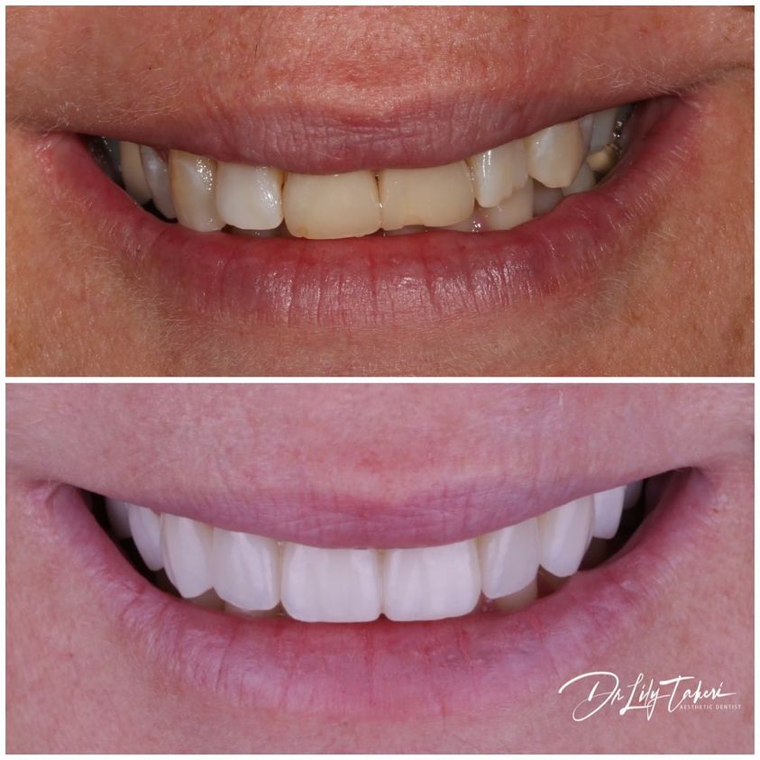 Composite Veneers Perth | Discover the Beauty and Durability