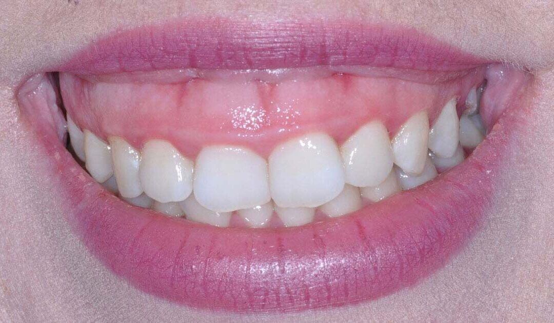 Gummy Smile Treatment in Connolly